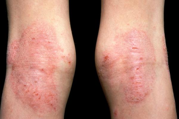 Skin rashes in children | nidirect