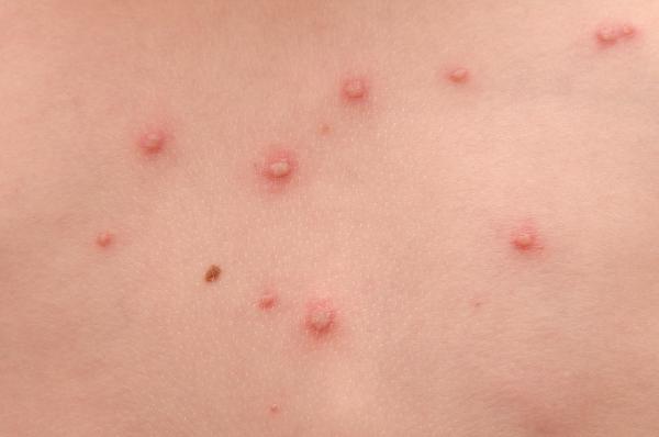 Skin rashes in children | nidirect