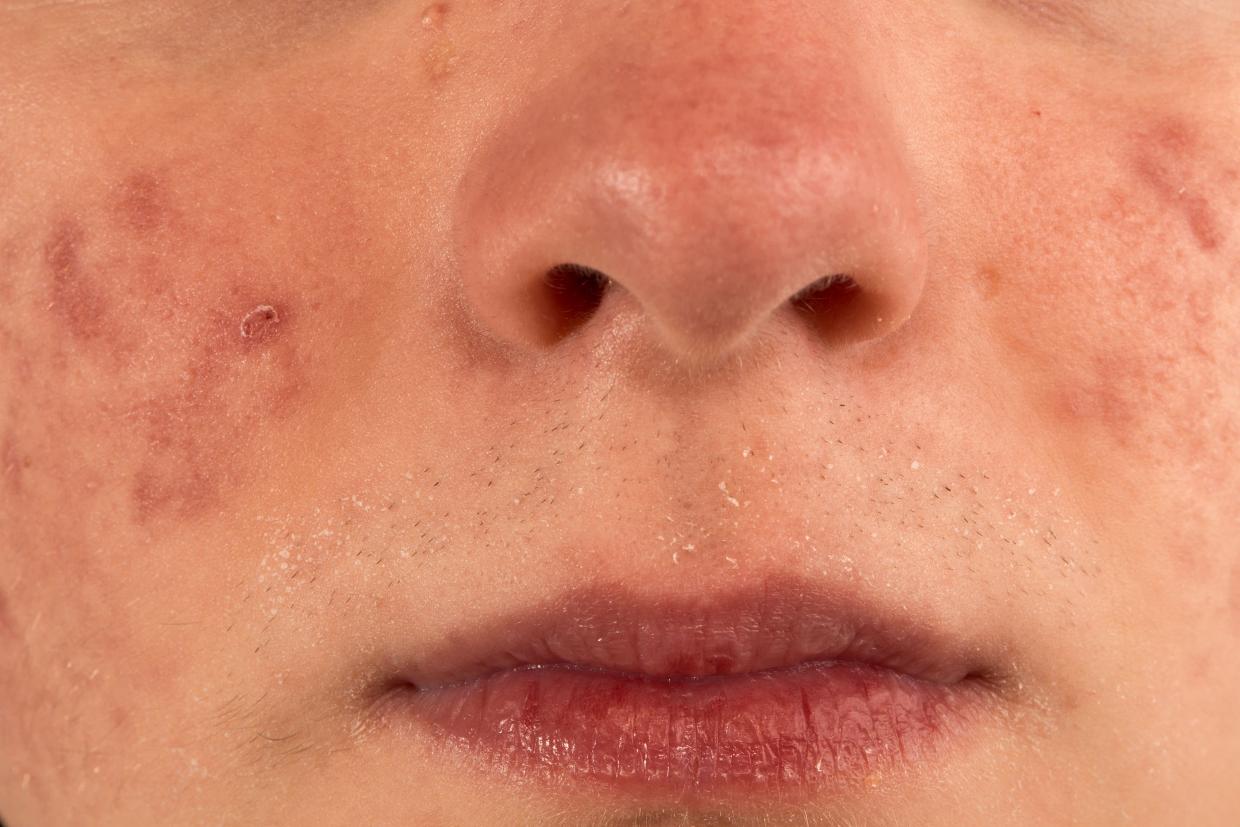 Acne Nidirect Acne Nidirect