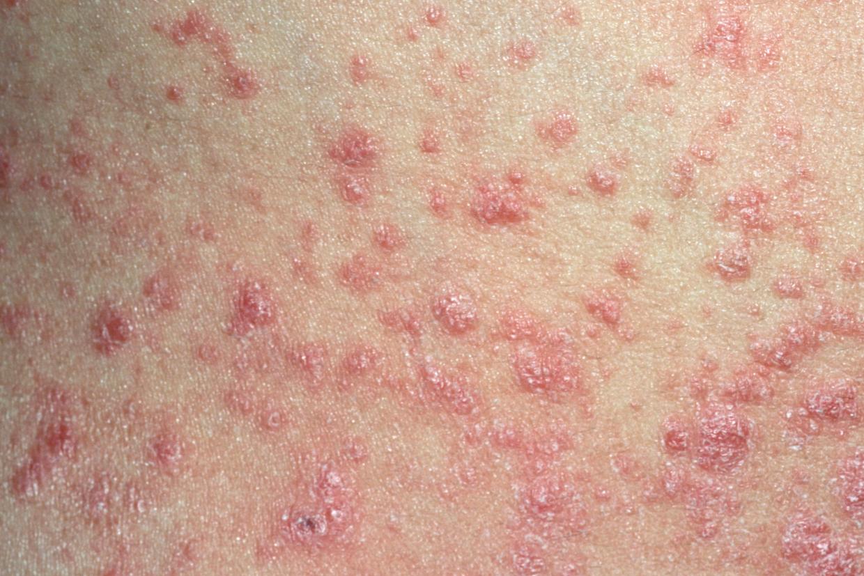 Psoriasis | nidirect