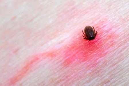 Tick-borne encephalitis (TBE) | nidirect