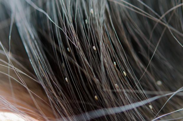 Head lice | nidirect