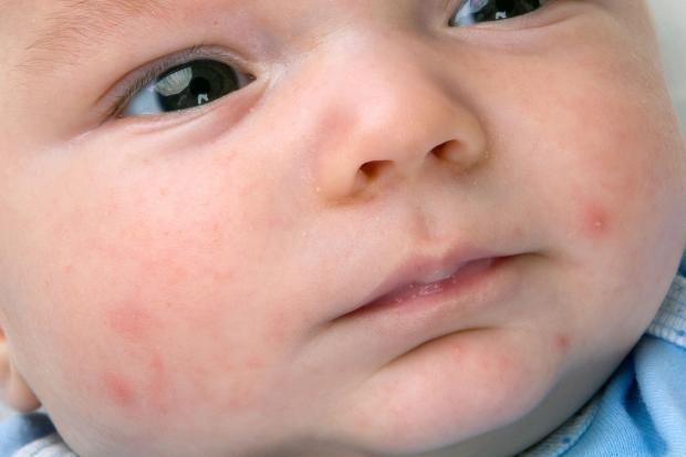 Skin rashes in babies | nidirect
