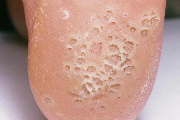 Warts and verrucas | nidirect