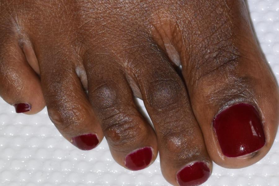 Corns and calluses | nidirect