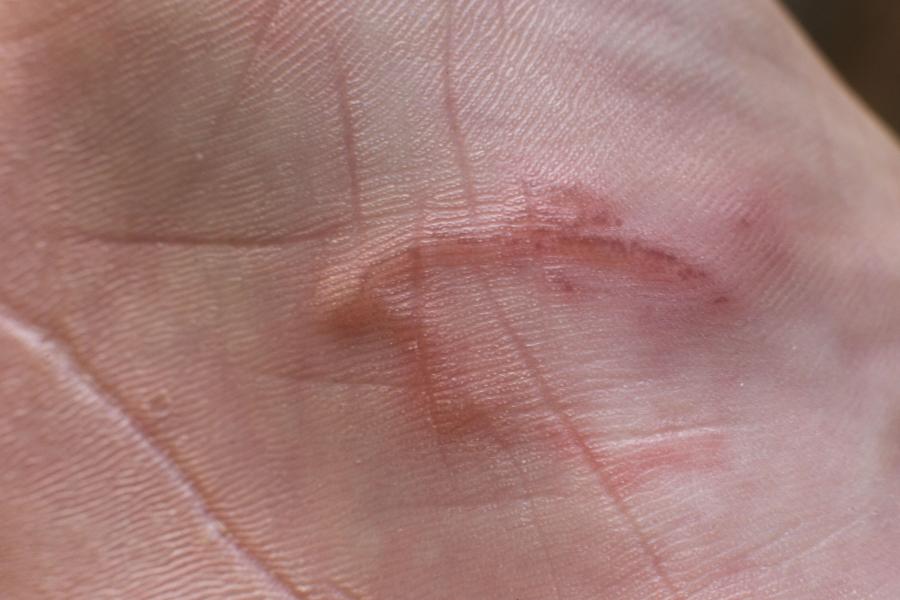 Worms in humans | nidirect